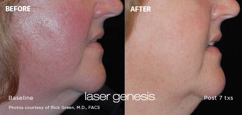 Laser Facials | Laser Genesis Treatment | Panhandle Medical Aesthetics